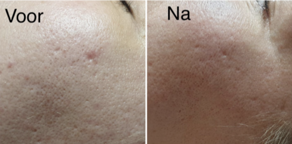 Acne-littekens - DermaCentrum Apeldoorn